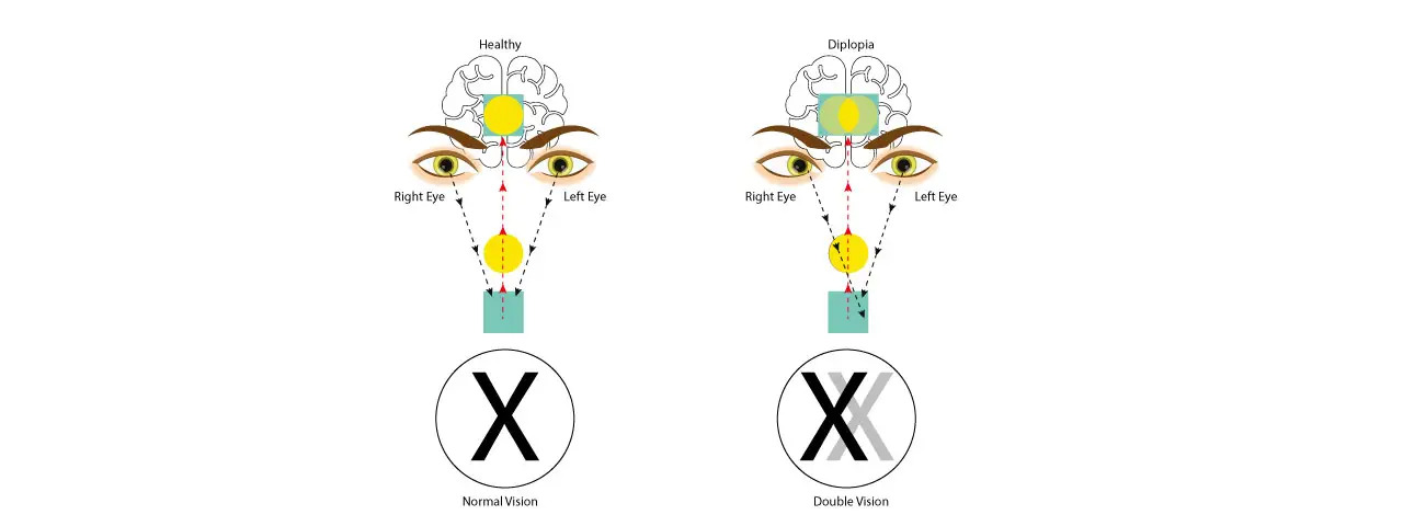 Qu'est-Ce Que La Vision Double (Diplopie) ? - Chirurgie plastique à ...