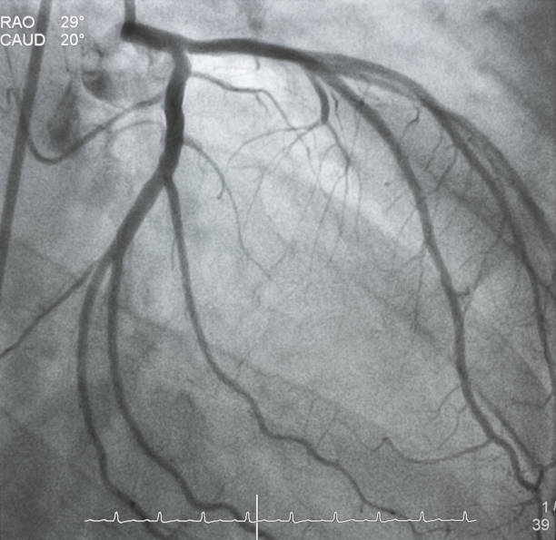 What is Coronary Angiography? - Plastic surgery in Istanbul