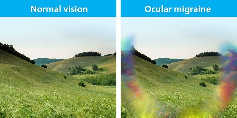 What is Eye Migraine? - Plastic surgery in Istanbul