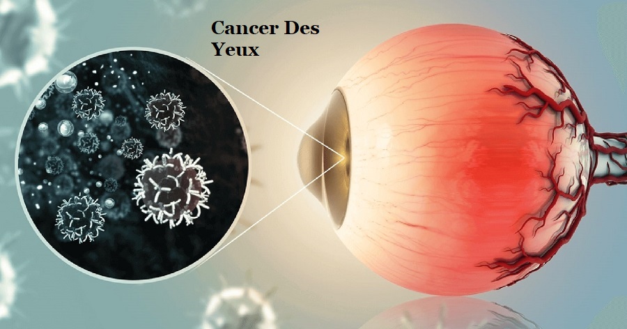 Qu’est-Ce Que Le Cancer Des Yeux ? - Chirurgie plastique à Istanbul
